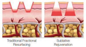 Sublative | Hull Dermatology & Aesthetics in Northwest Arkansas